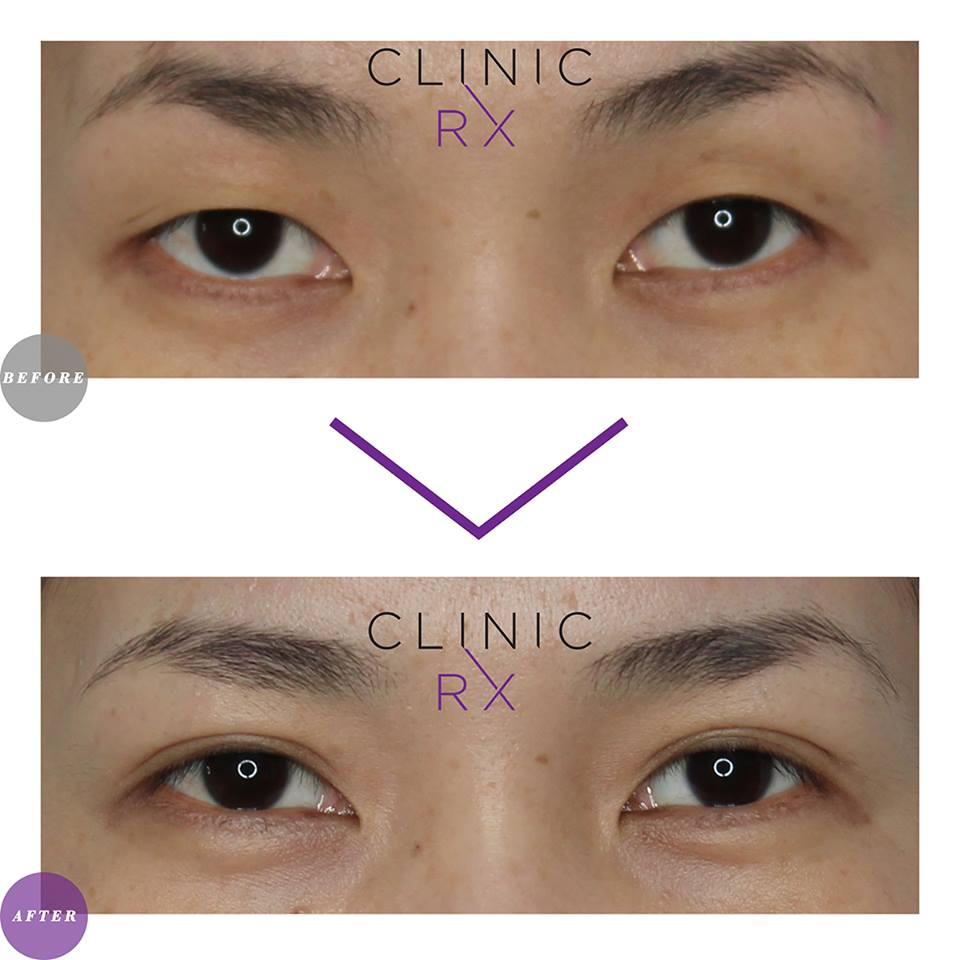 5 Differences Between Incisional And Non incisional Double Eyelid 5 Differences Between Incisional And Non incisional Double Eyelid